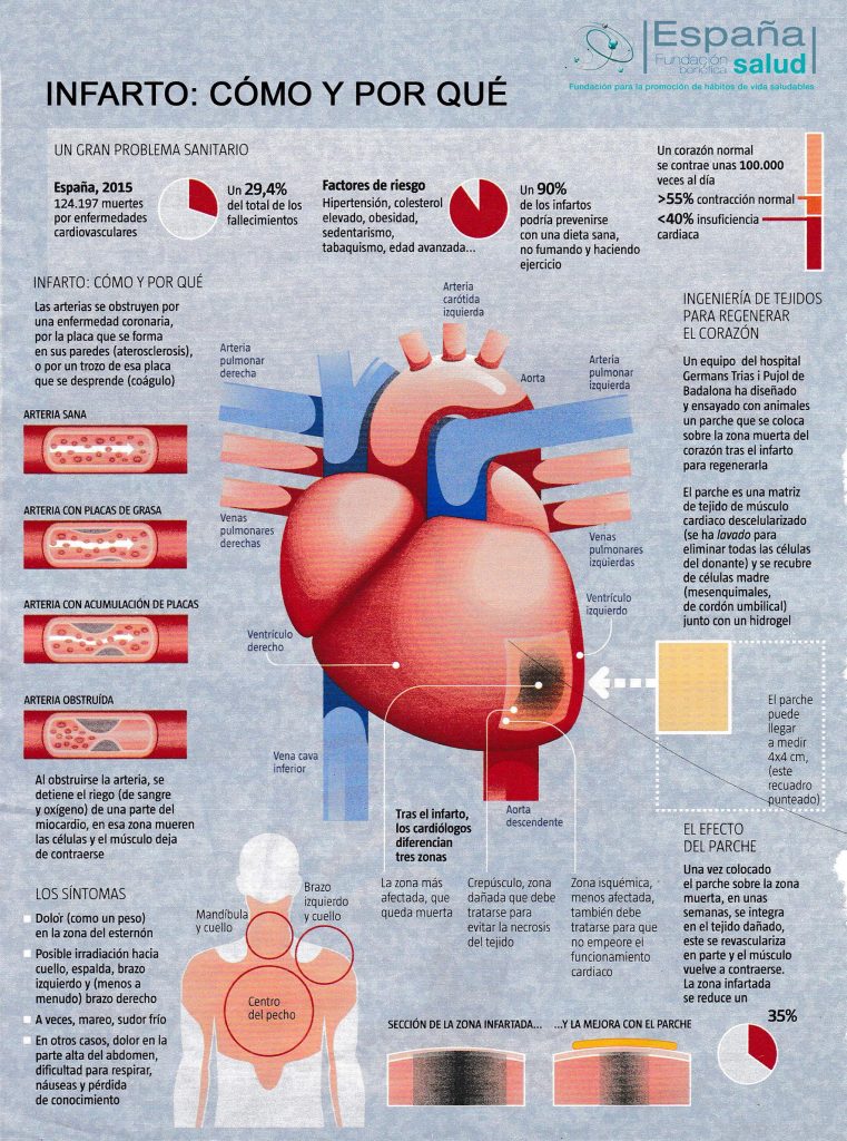 Infarto: cómo y por qué – España Salud